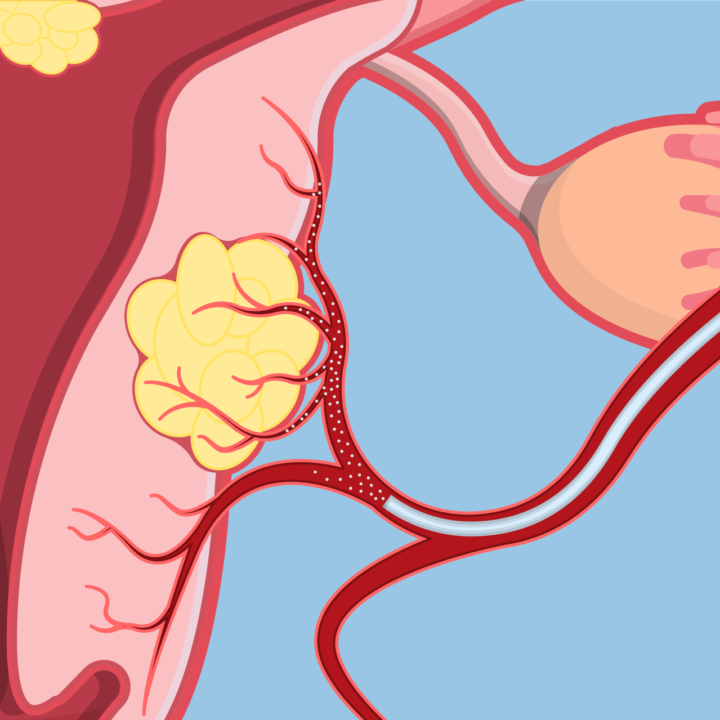 Uterine Artery Embolisation | Fibroid Treatment | Dr. Crowe