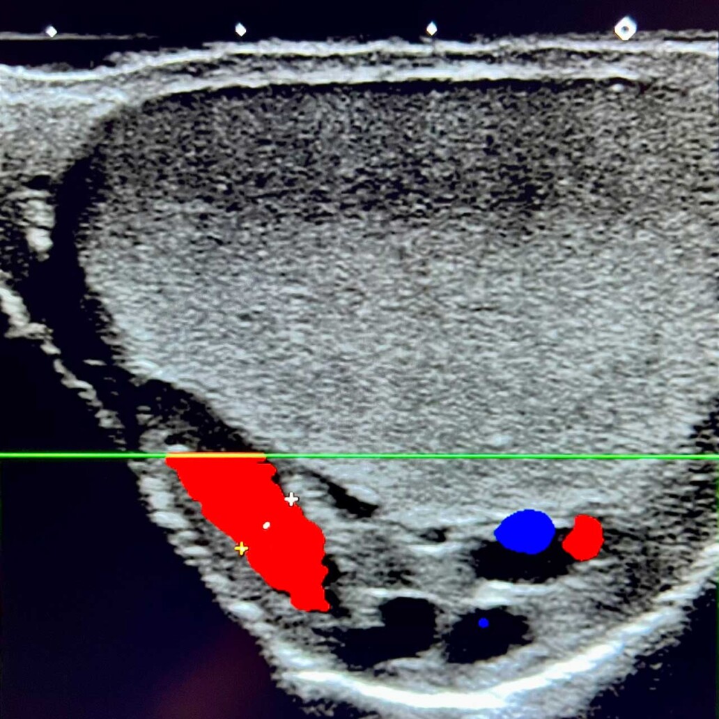 Varicocele Embolisation | Pelvic Congestion Syndrome | Dr Crowe