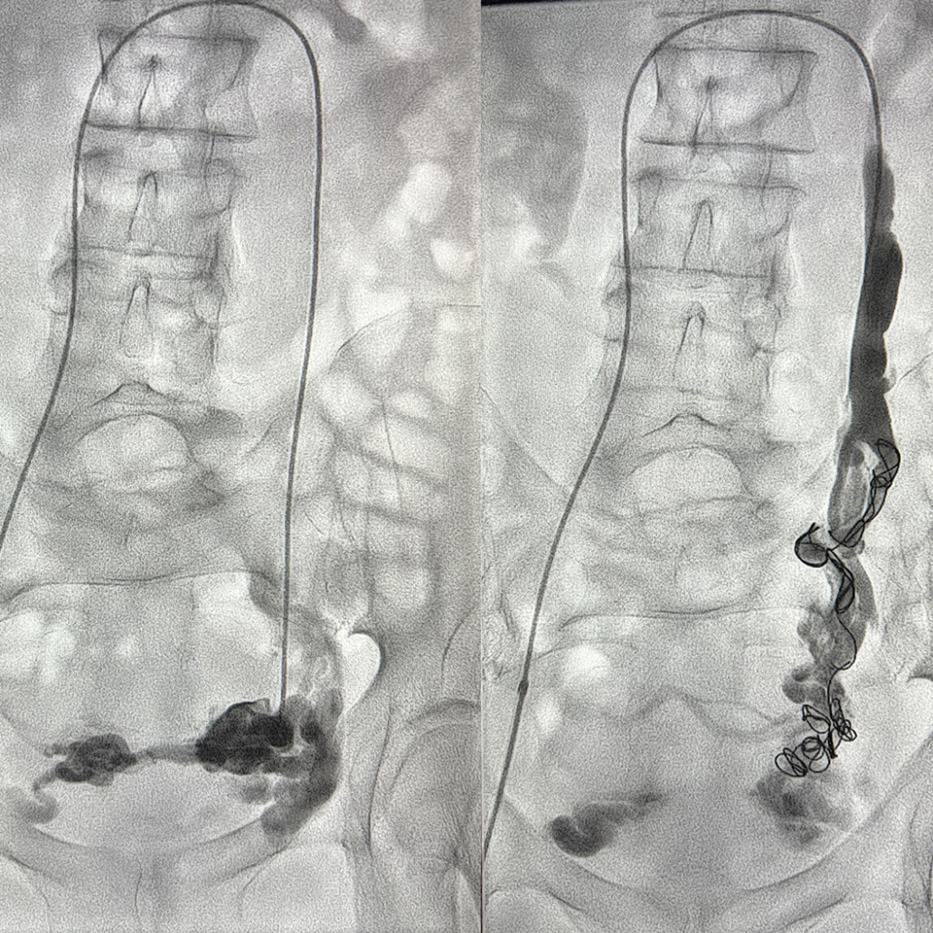 Varicocele Embolisation | Pelvic Congestion Syndrome | Dr Crowe