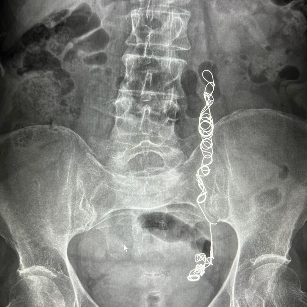 Embolisation for Pelvic Congestion | Dr Paul Crowe